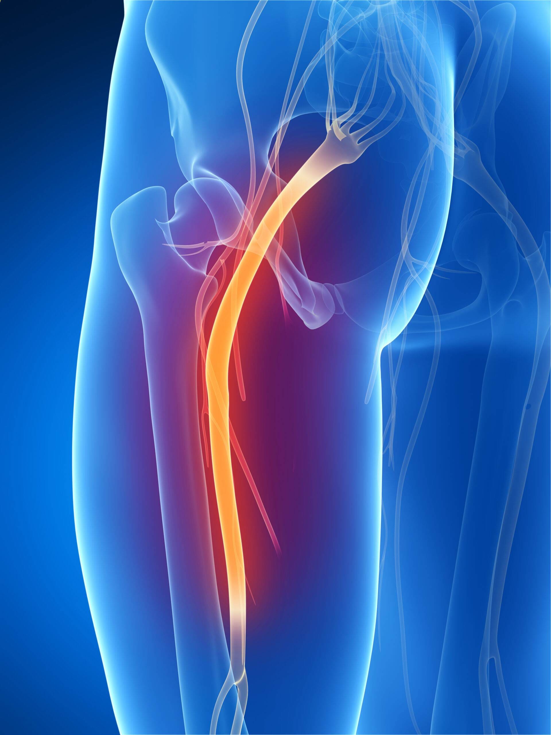 Sciatica & Sciatic Nerve Relief - Carolina Chiropractic Plus